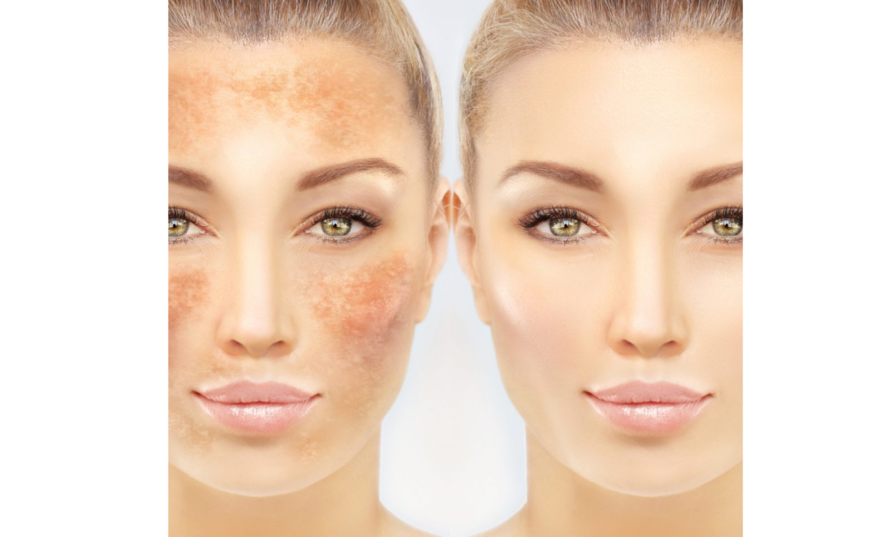 Treatment - Kotil Skin Science