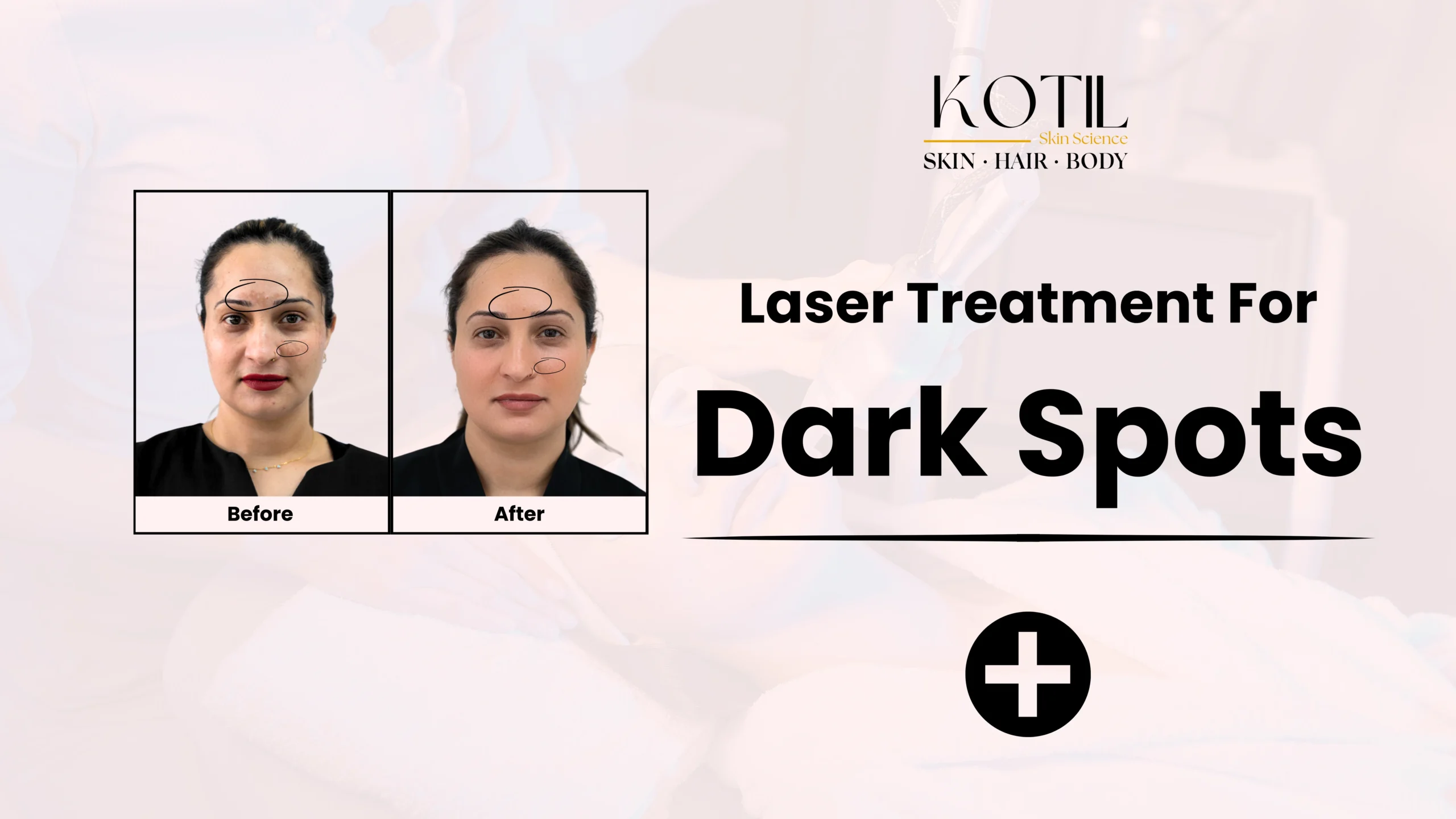 Laser Treatment for Dark Spots 2025 | Healthy Care in India | Kotil