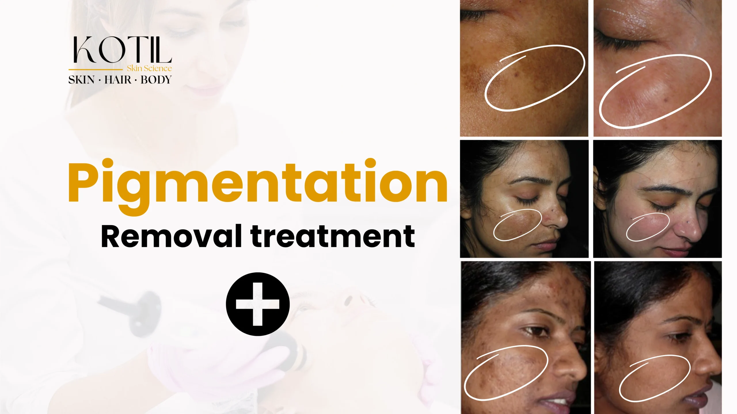 Pigmentation Removal Treatment for Glowing Skin 2025 | Kotil Skin